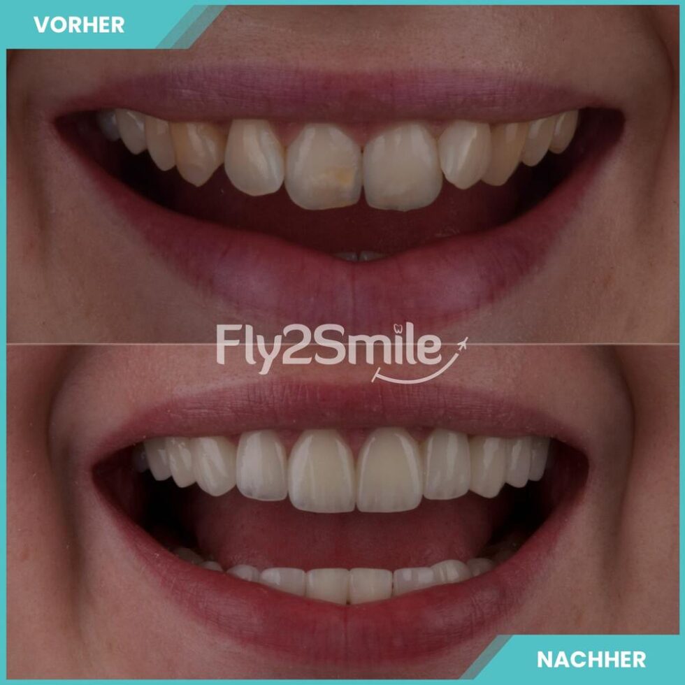 Veneers oder Kronen für beschädigte und brüchige Zähne - Fly2Smile